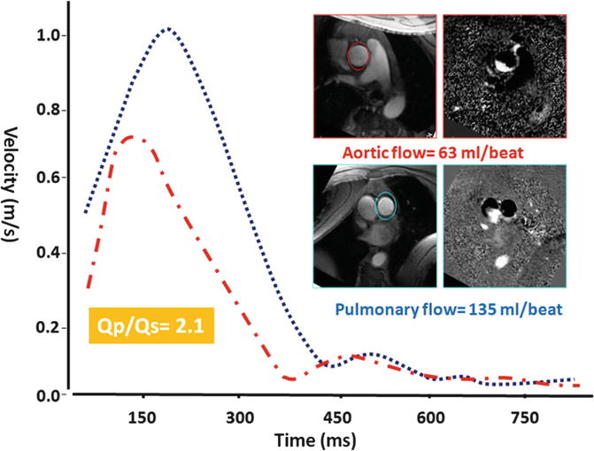 Cardiac Shunts: ASD, VSD, PDA | SpringerLink