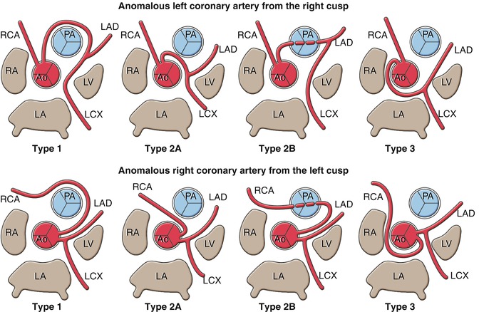 Coronary Artery Anomalies | SpringerLink