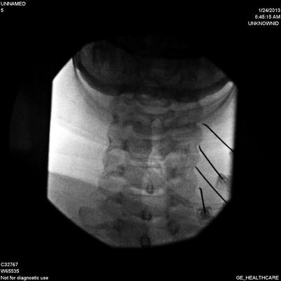 Cervical Facet Syndrome: Cervical Medial Branch Block and ...