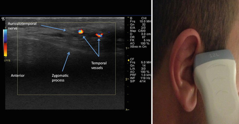 Peripheral Nerve Block for the Management of Headache and Face Pain ...