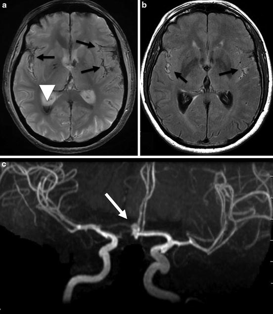 Aneurysmal Subarachnoid Hemorrhage | SpringerLink