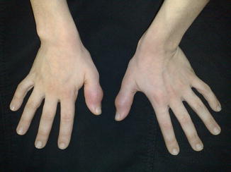 Hand Function in Juvenile Idiopathic Arthritis | SpringerLink