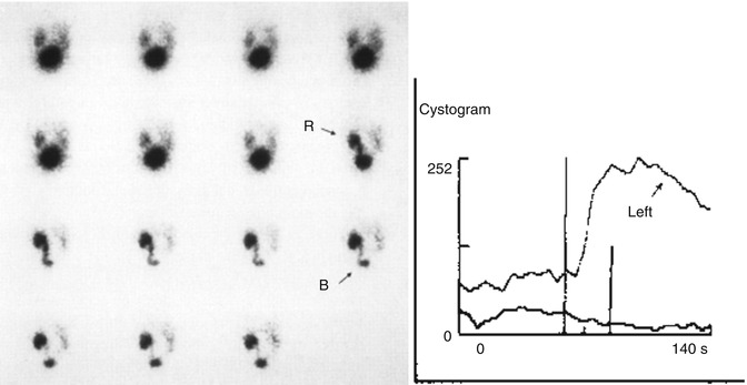 Vesicoureteral Reflux and Radionuclide Cystography | SpringerLink