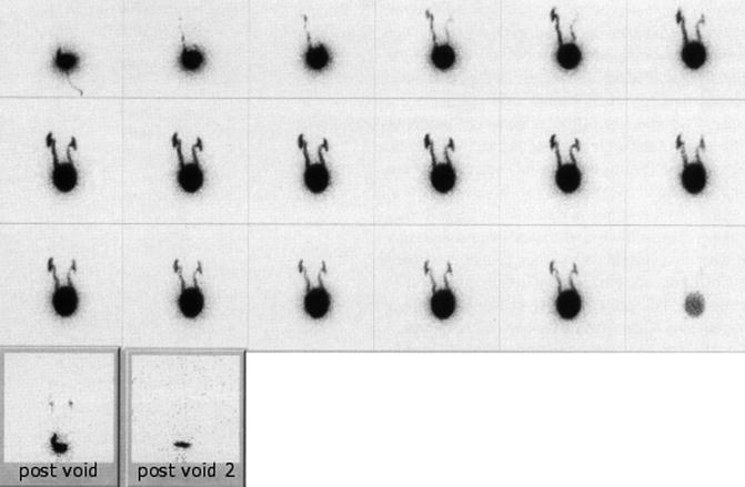 Vesicoureteral Reflux and Radionuclide Cystography | SpringerLink