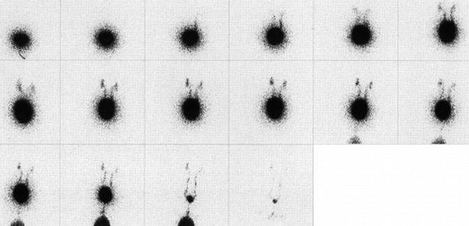 Vesicoureteral Reflux and Radionuclide Cystography | SpringerLink