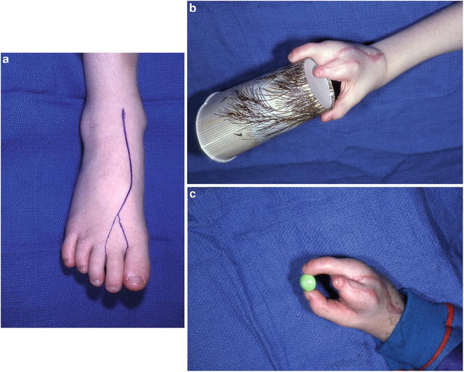 Symbrachydactyly | SpringerLink