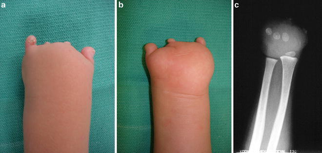 Symbrachydactyly | SpringerLink