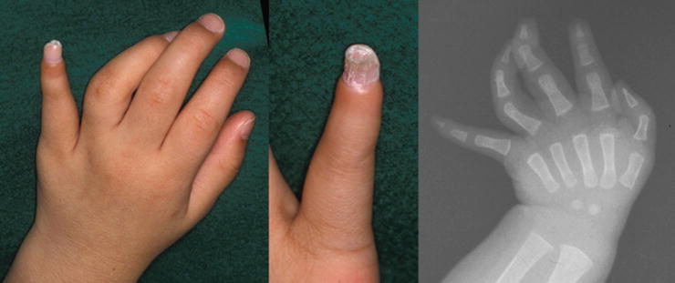 Central Deficiency (Cleft Hand) | SpringerLink