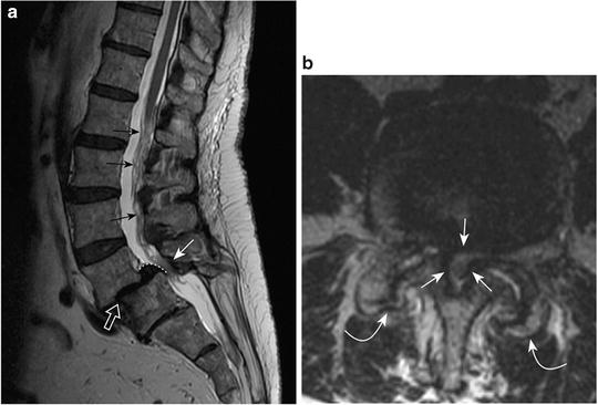 Imaging Techniques for the Diagnosis of Spondylolisthesis | SpringerLink