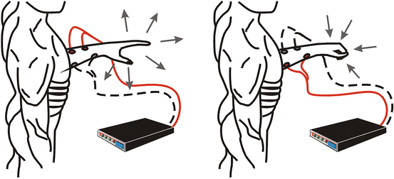Why Is Functional Electrical Stimulation Therapy Capable of Restoring ...