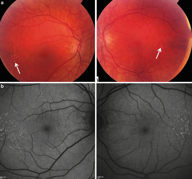 Natural History of Hydroxychloroquine and Chloroquine Retinopathy ...