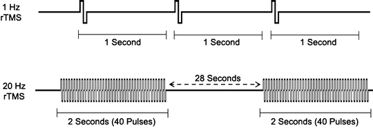 Repetitive Transcranial Magnetic Stimulation (rTMS) Protocols ...