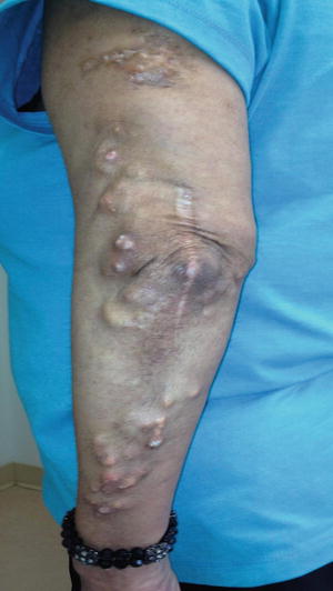 Calcinosis Cutis in Systemic Sclerosis | SpringerLink