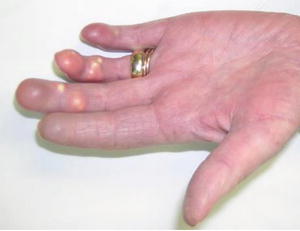 Calcinosis Cutis in Systemic Sclerosis | SpringerLink