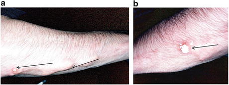 Calcinosis Cutis in Systemic Sclerosis | SpringerLink
