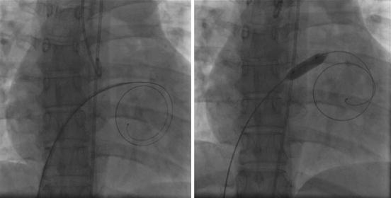 Atrial Septostomy | SpringerLink