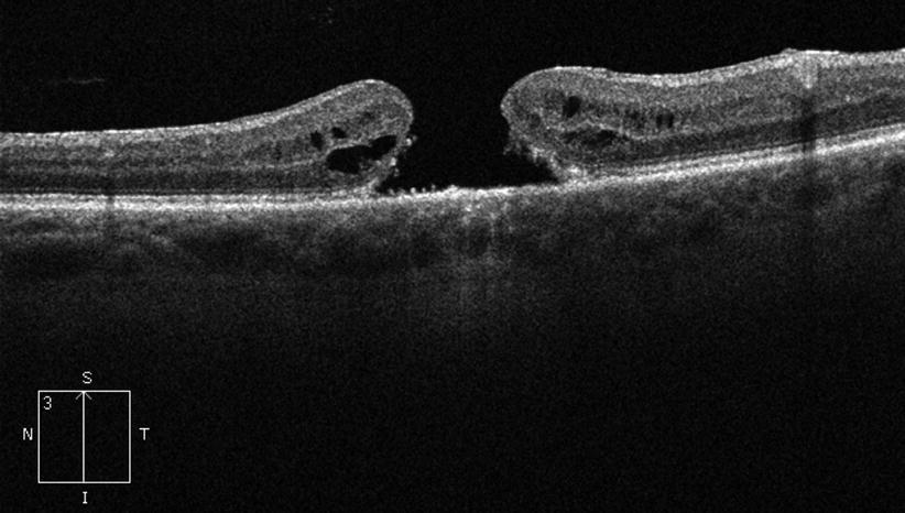 III.D. Vitreo-Macular Adhesion/Traction and Macular Holes: Pseudo ...