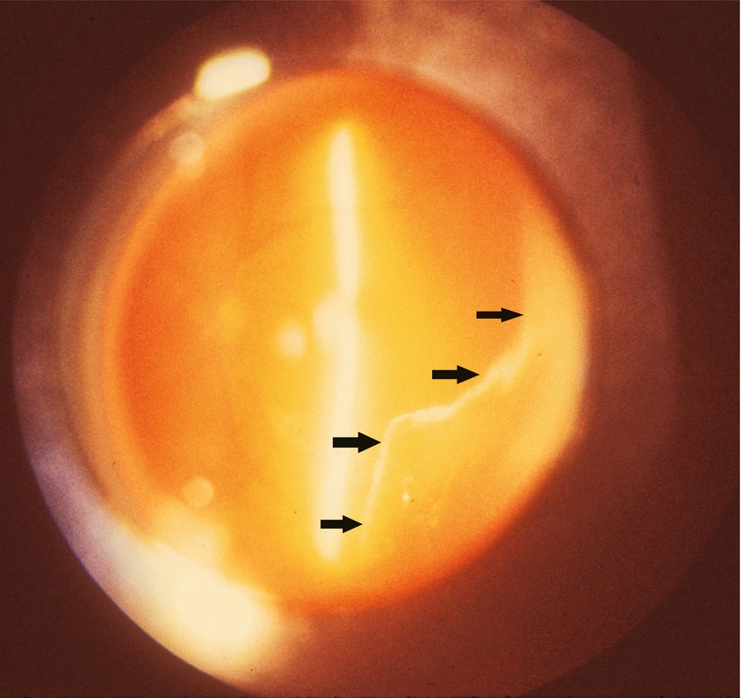 II.C. Vitreous Aging and Posterior Vitreous Detachment | SpringerLink