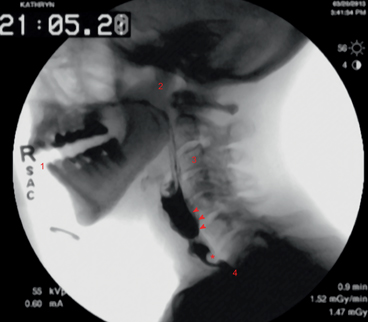 The Videofluoroscopic Swallow Study Technique and Protocol | SpringerLink