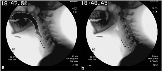Objective Measures on Videofluoroscopic Swallow Studies | SpringerLink