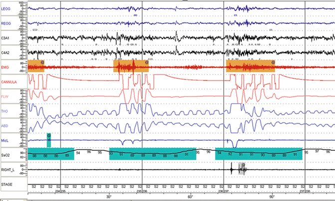 Polysomnography: An Overview | SpringerLink