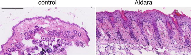 Aldara-Induced Psoriasis-Like Skin Inflammation: Isolation and ...