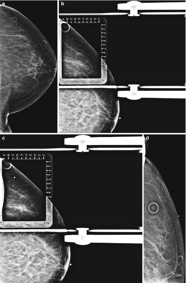 Mammography Techniques, Positioning, and Optimizing Image Quality ...