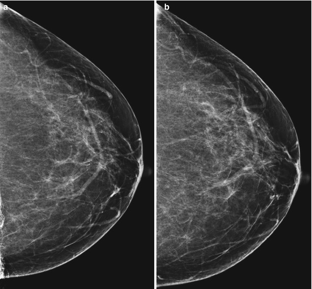 Mammography Techniques, Positioning, and Optimizing Image Quality ...