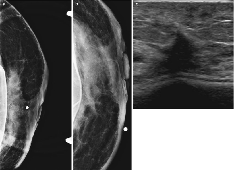 Mammographic Signs of Breast Cancer | SpringerLink