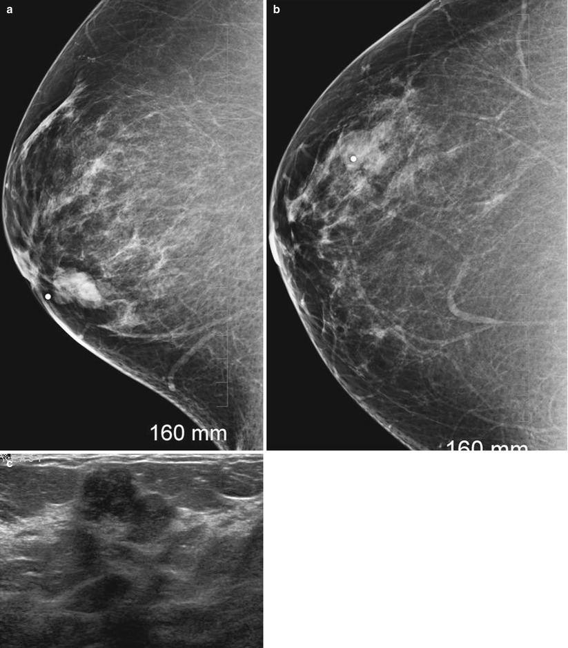 Mammographic Signs of Breast Cancer | SpringerLink