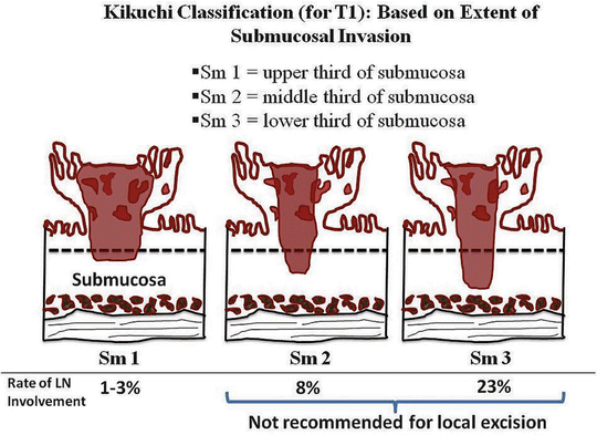 Local Excision of Early-Stage Rectal Cancer | SpringerLink
