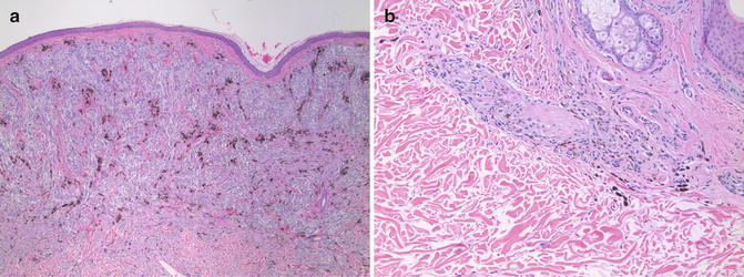 Blue Nevus Versus Pigmented Epithelioid Melanocytoma | SpringerLink
