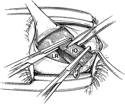 Inferior Oblique Muscle Weakening Procedures | SpringerLink