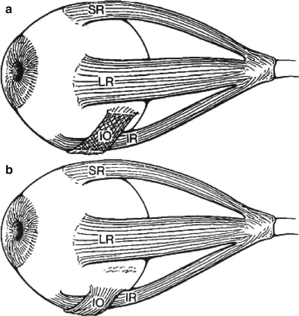 Inferior Oblique Muscle Weakening Procedures | SpringerLink