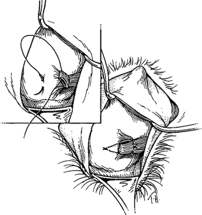 Superior Oblique Tendon Tightening Procedures | SpringerLink