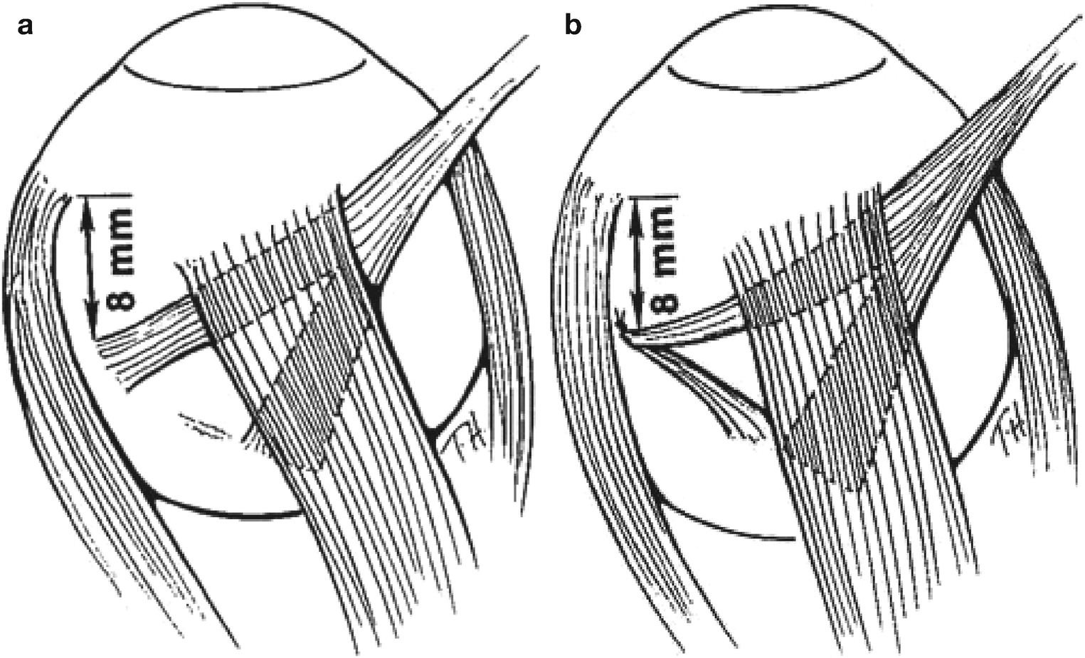 Superior Oblique Tendon Tightening Procedures | SpringerLink