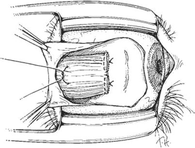 Faden Operation (Posterior Fixation Suture) | SpringerLink