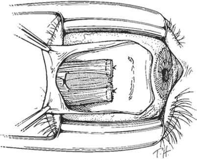 Faden Operation (Posterior Fixation Suture) | SpringerLink