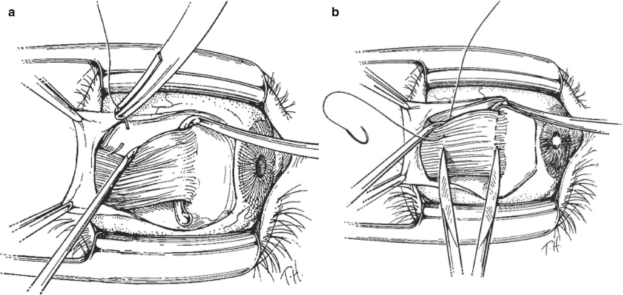 Faden Operation (Posterior Fixation Suture) | SpringerLink
