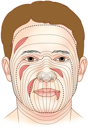 Defect Closure After Lesion Excision of the Face | SpringerLink