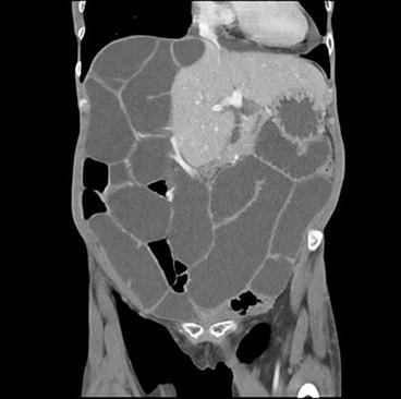 Chronic Intestinal Pseudo-obstruction | SpringerLink