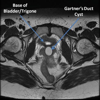 Excision of Vaginal Cysts | SpringerLink