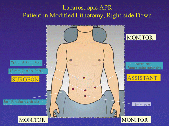 Laparoscopic Abdominoperineal Resection | SpringerLink