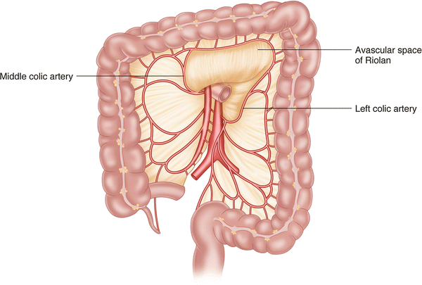 Laparoscopic Proctocolectomy | SpringerLink