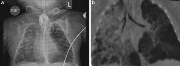 Tracheostomy for the Neonate and Infant: Indications, Complications ...