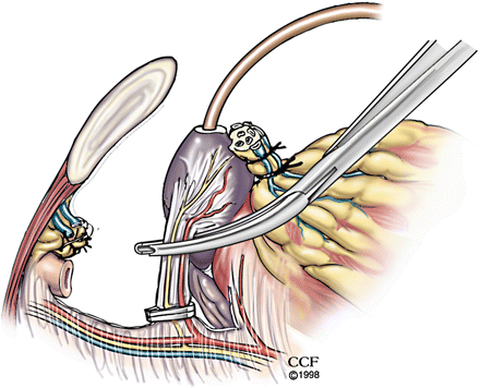 Open Radical Retropubic Prostatectomy and Pelvic Lymph Node Dissection ...