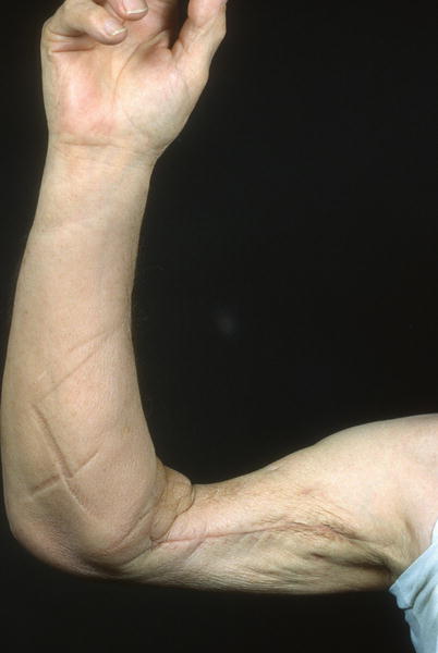 Tumor in the Anterior Compartment of the Arm | SpringerLink