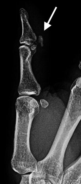 Soft Tissue Calcifications | SpringerLink