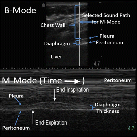 Diaphragm Ultrasound in the Intensive Care Unit | SpringerLink