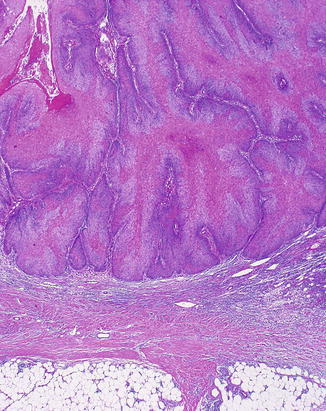 Squamous Cell Carcinoma of the Vulva | SpringerLink